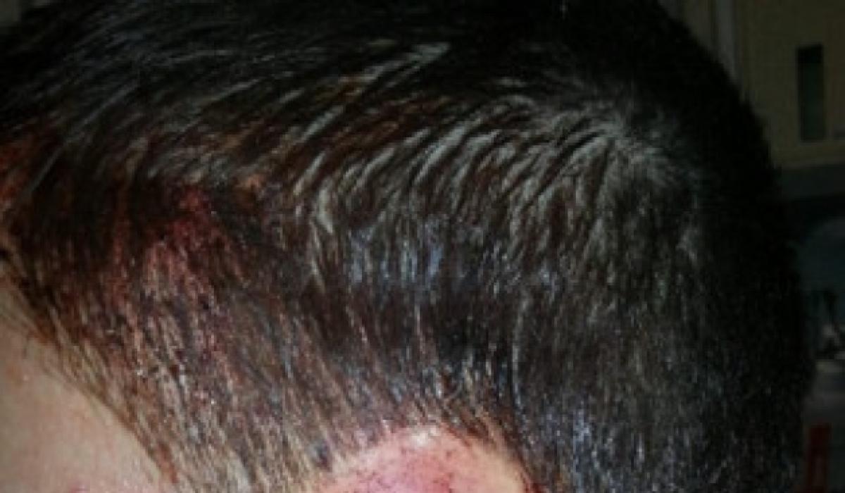 Kilkenny man caught MRSA after ear bitten off in vicious, savage attack ...